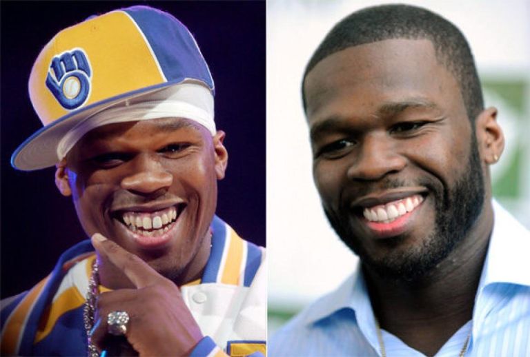 5 Rappers That Got Traded In Grills For Perfect Teeth